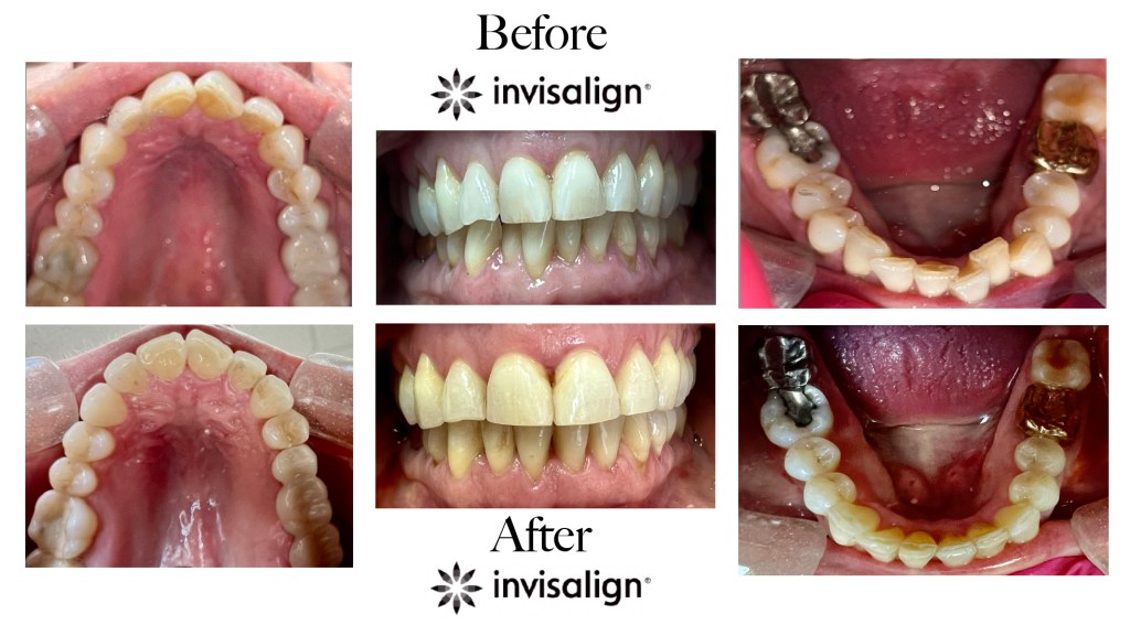 Before & After Dental Photos | Cosmetic Dentist Dentist in Lombard IL